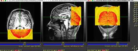 Partial Coverage Alignment Afni Message Board Afni Discuss Message