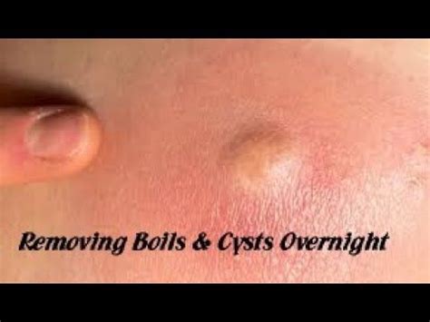Top 3 Home Remedies For Boils Under Armpits How To Get Rid Of A Boil