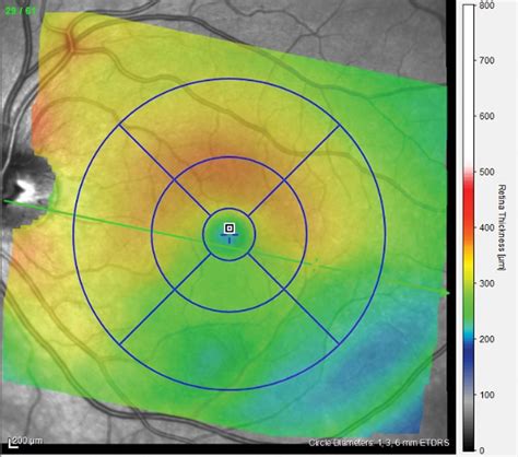 Branch Retinal Artery Occlusion Visual Field Defect