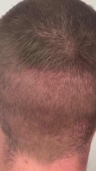 Healed Donor Area Video Realself