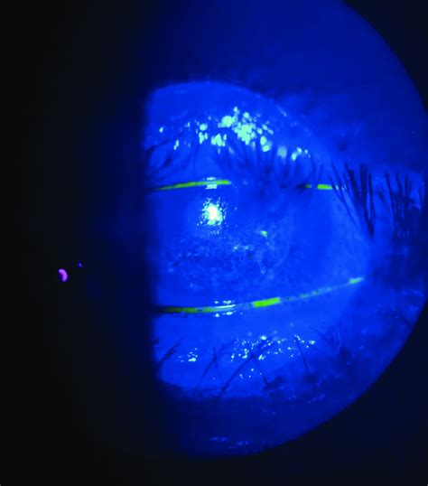 After 2 Weeks Of The Treatment Dendritic Ulcers Were Resolved With