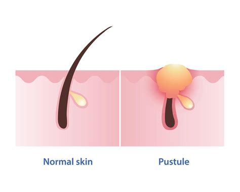 Why Do Pimples Have Different Types Of Pus