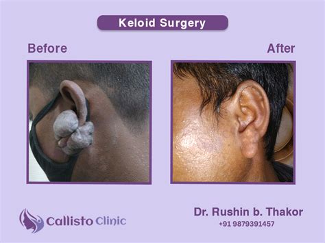 Keloid Surgery Ear Callisto Clinic
