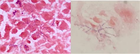 Thin Beaded Branching Gram Positive Bacilli Seen On Gram Stain Of Right