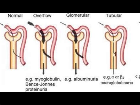 Understanding Overflow Proteinuria Bence Jones Protein YouTube