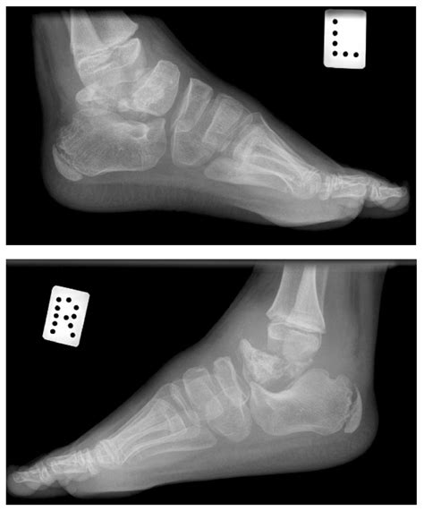 Multicentric Osteolysis Nodulosis And Arthropathy Mona Pacs