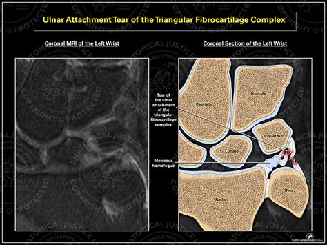 Ulnar Attachment Tear Of The Triangular Fibrocartilage Complex