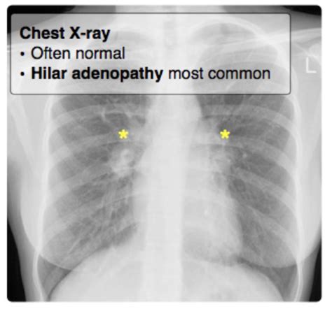 Tuberculosis Flashcards Quizlet