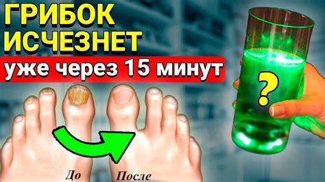 Мало кто Знает Это копеечное средство уберет ГРИБОК НОГТЕЙ за 15 минут Youtube