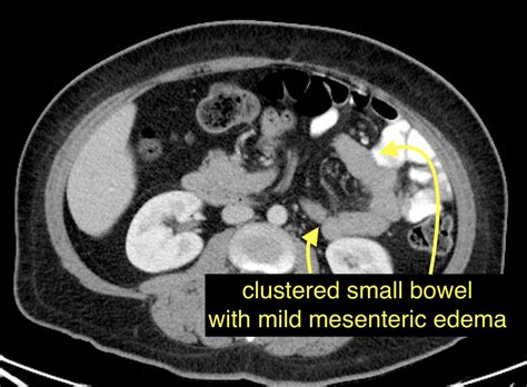 Post Gastric Bypass Internal Hernia Radiology At Carrie Hernandez Blog