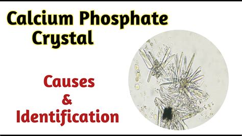 Calcium Phosphate Crystals In Urine Calcium Phosphate Crystals Youtube