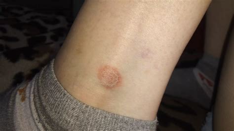 Дополнение к вопросу Чем лечить и что это такое Появилось пятно на ноге Medaboutme