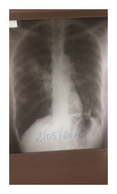 Reticulonodular Infiltrates At The Apex Of The Right Lungs Associated Download Scientific