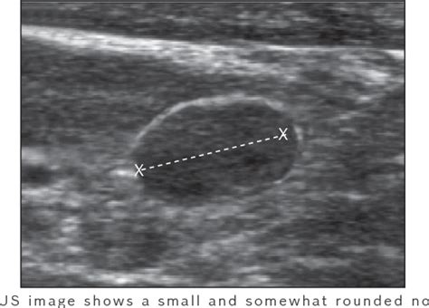 [pdf] Post Thyroidectomy Neck Ultrasonography In Patients With Thyroid