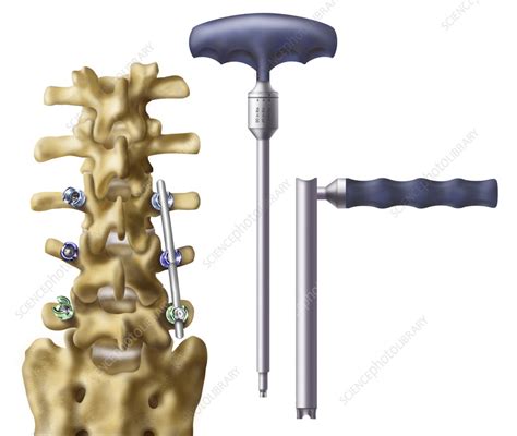 Spinal Surgery Illustration Stock Image C0612208 Science Photo