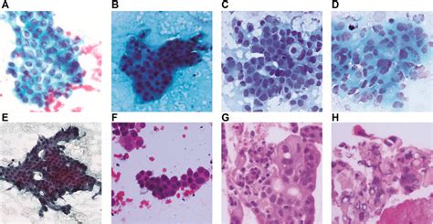 Frontiers Pancreasys An Automated Cloud Based Pancreatic Cancer Grading System