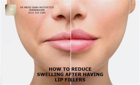 Is It Normal To Have White Dots On Your Lips After Filler