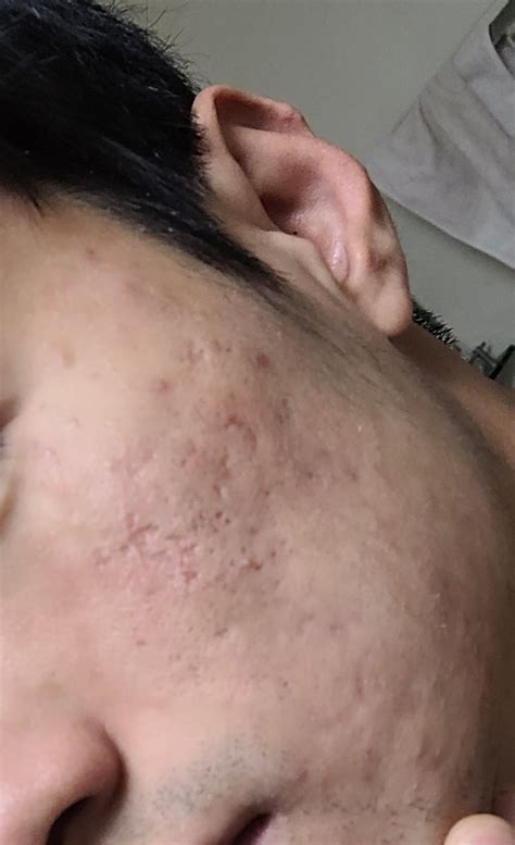 남자 여드름 흉터 지식in