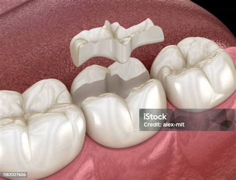 치아 위에 세라믹 크라운 고정 인간의 치아 치료의 의학적으로 정확한 3d 그림 상감 세공에 대한 스톡 사진 및 기타 이미지 상감 세공 이빨 3차원 형태 Istock