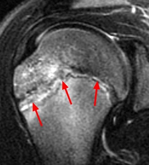 Salter Harris Fractures Radsource