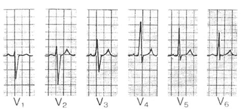R Wave Ecg Book