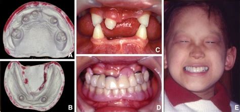 Double Crown Removable Partial Denture For A Patient With Ectodermal