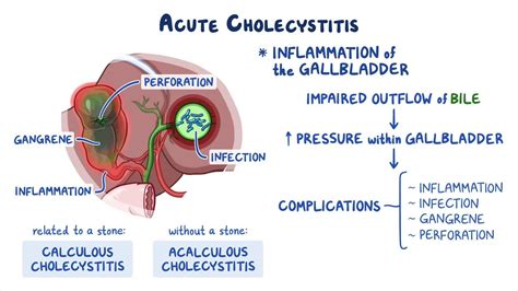 Cholecystitis Clinical Sciences Osmosis Video Library