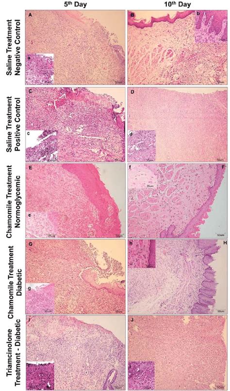 Photomicrograph Of Ulceration In The Buccal Mucosa In The Saline