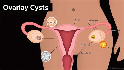 Relief For Burst Cyst On Ovary Pain Explained