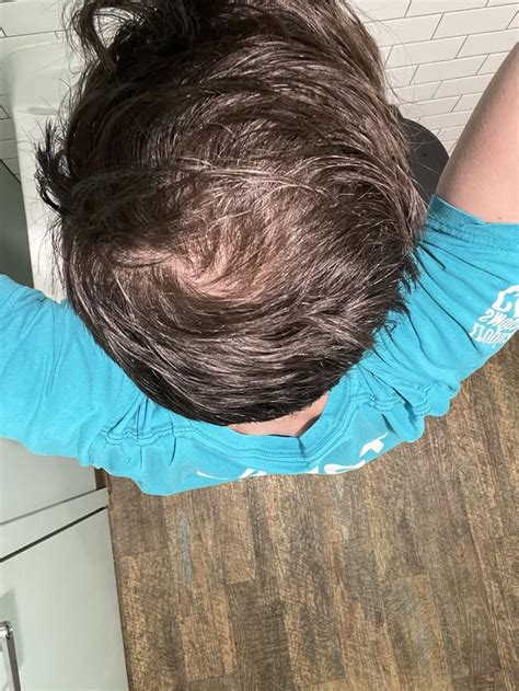 Am I Diffuse Thinningbalding Rbald