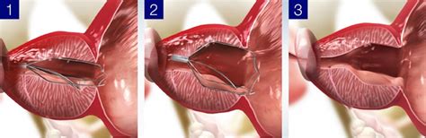 Itind Bph Enlarged Prostate Therapy