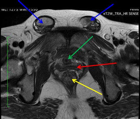 Testicular Feminization Syndrome Pacs