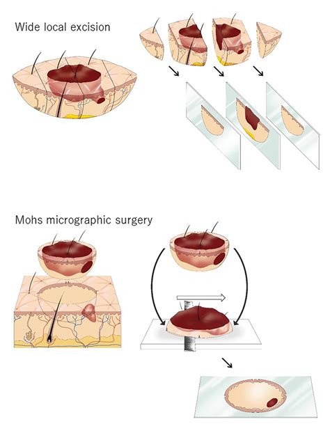 Barriers To Mohs Micrographic Surgery In Japanese Patients With Basal Cell Carcinoma Mdedge