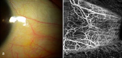 A A Slit Lamp Photograph Showing Moderate Conjunctival Hyperemia Of A Download Scientific