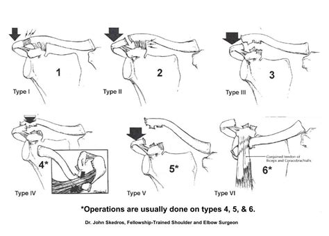 Shoulder Separation Procedures Dr Skedros Orthopaedics