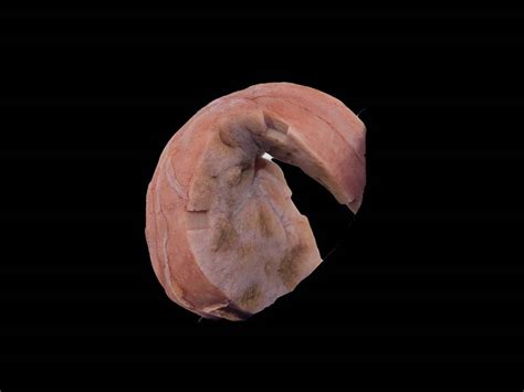 High Simulation Silicone Hepatic Vascular Endothelial Cell Sarcoma Model