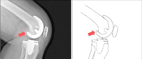 Postoperative Radiograph A And Line Drawing B Showing Posterior