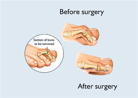 How To Fix Hammer Toes