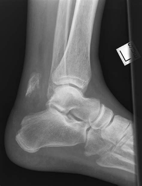Anterior Calcaneus Fracture