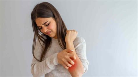 Heat Rash Symptoms Causes And Treatment Of Prickly Heat Healthshots