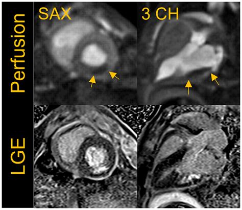 First Pass Perfusion Images Acquired At Rest With A Fat Suppressed Download Scientific Diagram