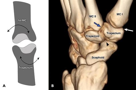 Radiologic Guide To Surgical Treatment Of First Carpometacarpal Joint Osteoarthritis Ajr