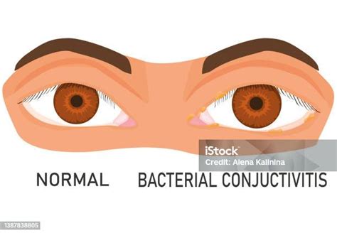 세균성 결막염을 가진 눈의 삽화 안구 질환 눈 자극 플랫 벡터 건강하고 병에 걸린 눈 건강관리와 의술에 대한 스톡 벡터 아트 및