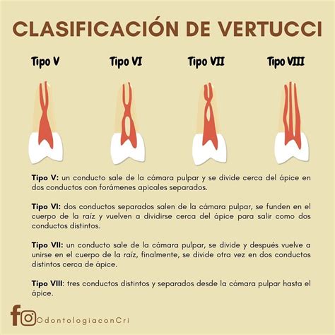 Clasificación De Vertucci Anestesia En Odontologia Odontología