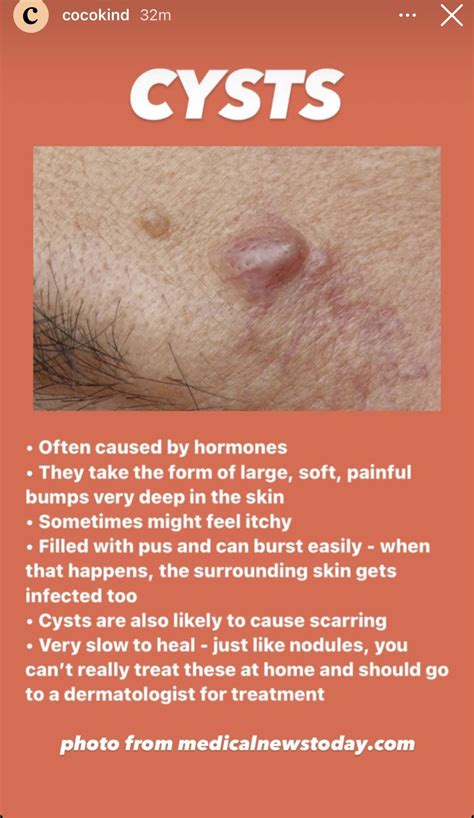 Folliculitis Scalp Treatment How To Treat Folliculitis Bumps On Scalp Artofit