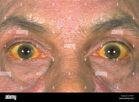 Jaundice Cirrhosis