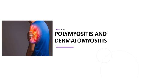 Exploring Polymyositis And Dermatomyositis Understanding The