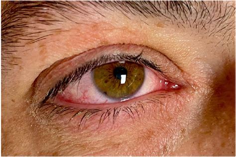 Right Eye Blepharoconjunctivitis With Conjunctival Hyperaemia And Mild