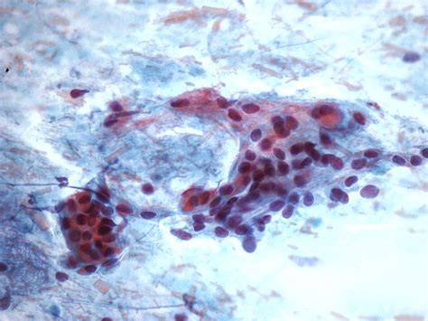 Fig 33 Non Neoplastic Sialolithiasis University Of Wisconsinmadison