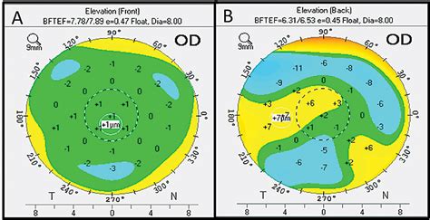 Angle Kappa May Affect Diagnostic Accuracy In Refractive Surgery Patients